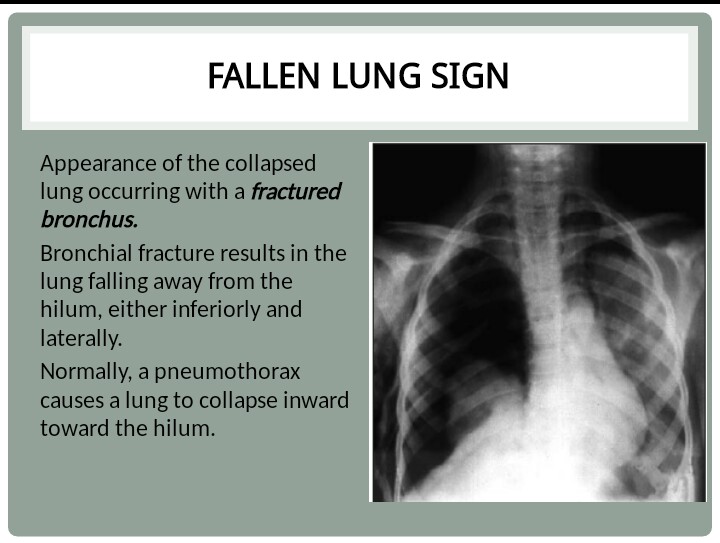Chest Medicine Made Easy-Dr Deepu: Fallen Lung Sign