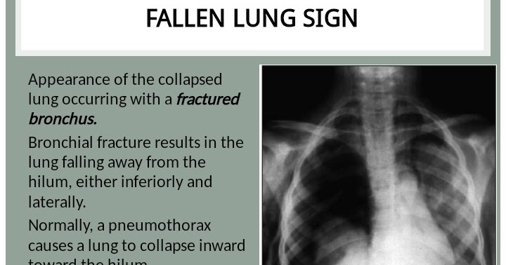 Chest Medicine Made Easy-Dr Deepu: Fallen Lung Sign