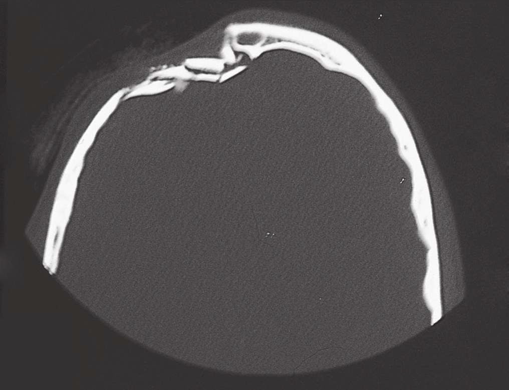 Study Medical Photos Depressed Skull Fracture study-medical-photos-depressed-skull-fracture