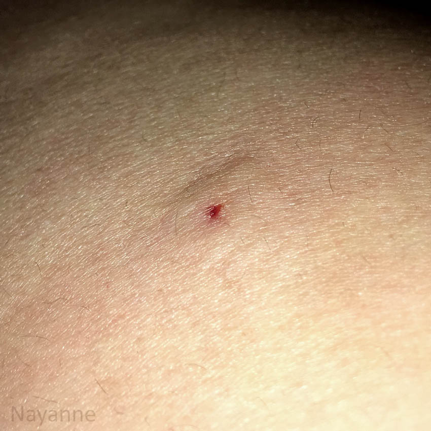 Picada De Percevejo Fotos - RETOEDU