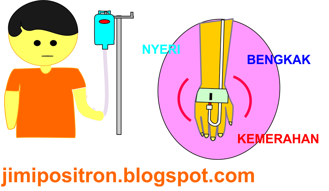 Ekstravasasi ( bengkak akibat resiko pemasangan infus atau pemberian ...