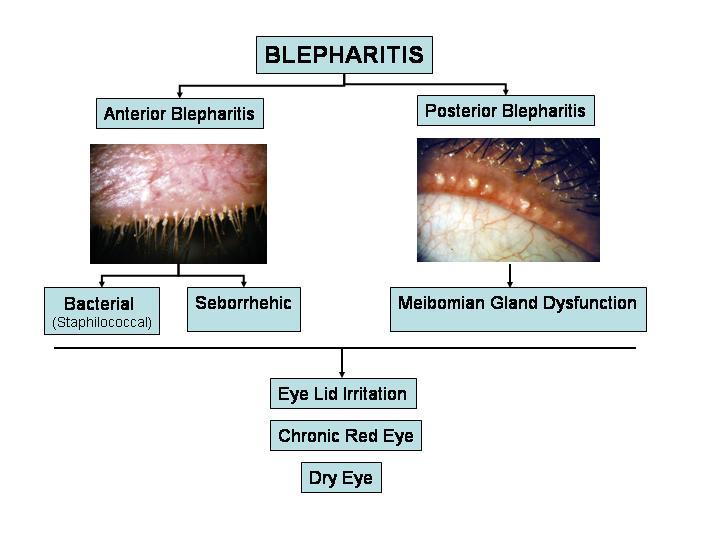 Blepharitis - Eye Infection - Symptoms - Natural Remedies ~ Medicinal Words