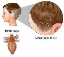 Lice infestation | Chronic Sore Throat