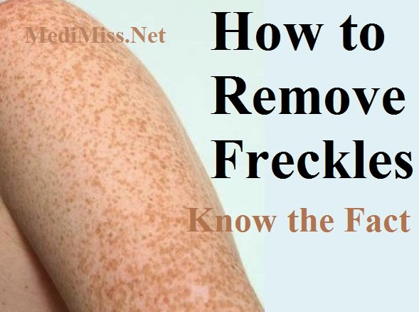 Guide To White: Guide How to get rid of freckles effectively