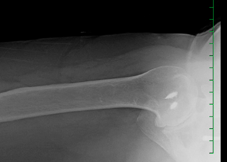 Shoulder and Elbow Surgery: Reverse shoulder replacement for cuff tear ...