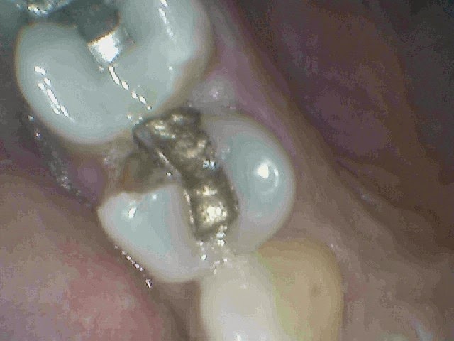 www.BestOgdenDentist.com Blog: A cavity being filled. Step by Step.