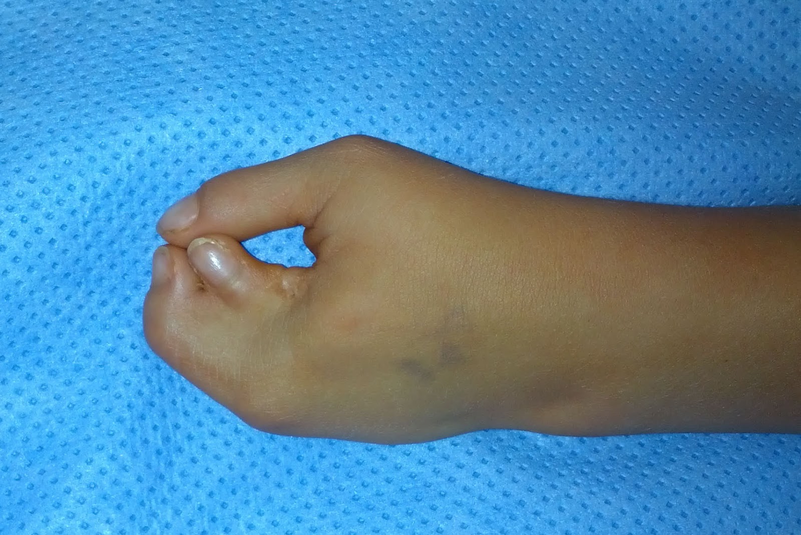 Symbrachydactyly Web Deepening | Congenital Hand and Arm Differences ...