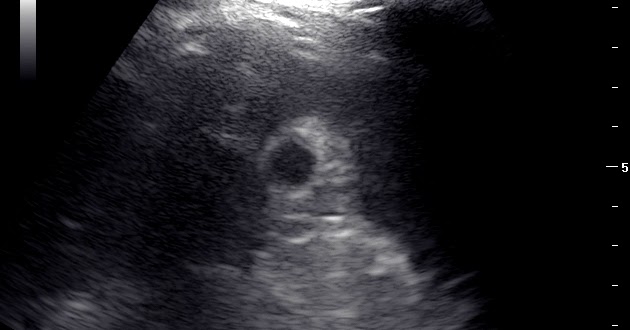 Pared Vesicular Engrosada