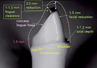 UPPER INCISOR CROWN PREPARATIONS: Step by Step - Odonto-Tv