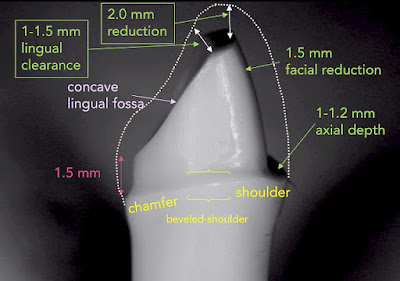 TOOTH PREPARATION: Anterior PFM preparation - Dr. Richard Stevenson