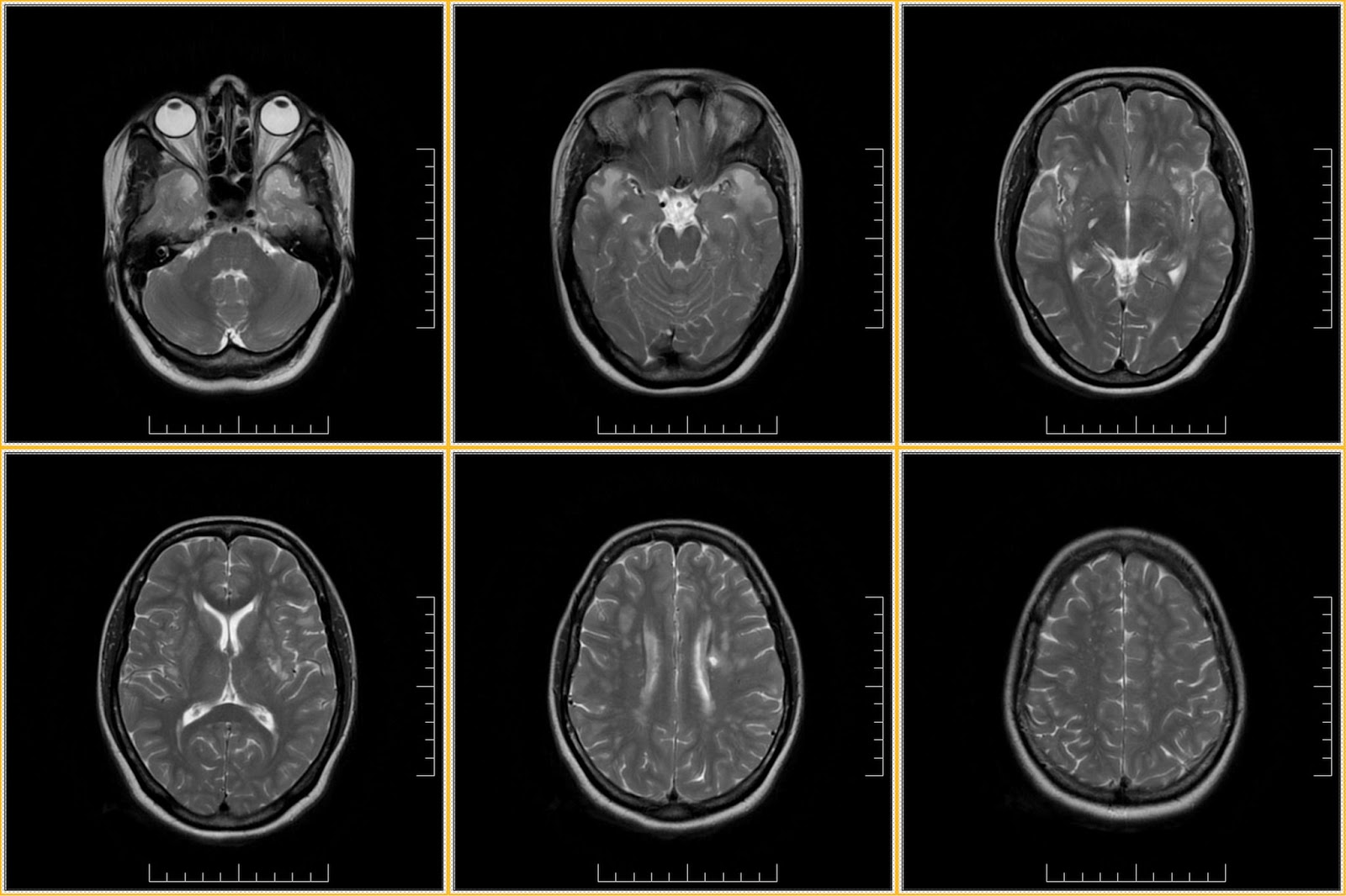 Dr Balaji Anvekar FRCR: CADASIL MRI Brain