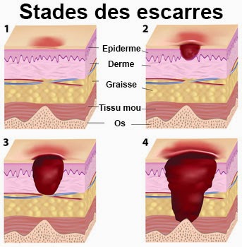 Les escarres | Récap' IDE