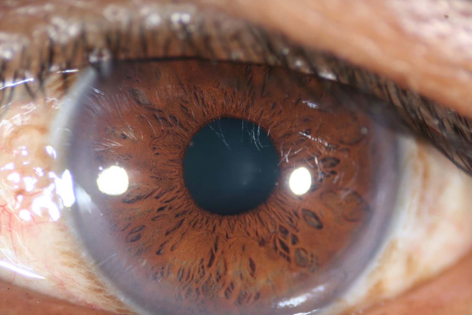 Modern & Multidimensional Iridology: Localised Absence of IPB, Pupil ...