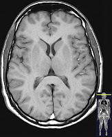 Sleep and Neurology: MRI and CT scans