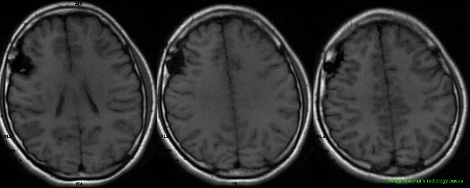 Dr Balaji Anvekar FRCR: Post Traumatic Leptomeningeal Cyst MRI