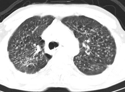 Silicosis- CT Findings - Sumer's Radiology Blog