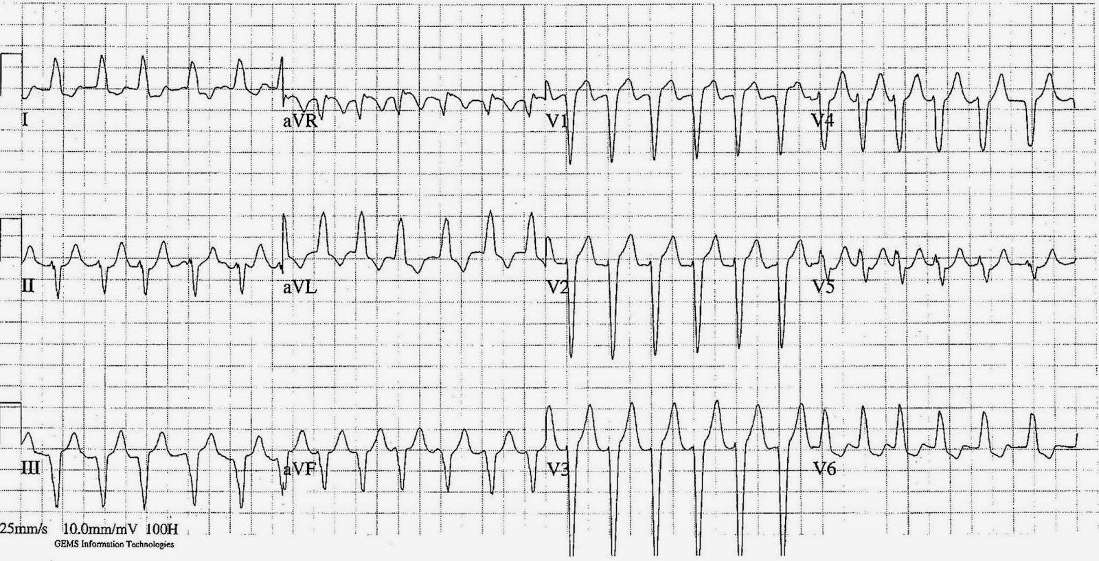 ECG of the Week: ECG of the Week - 15th September 2014 - Interpretation