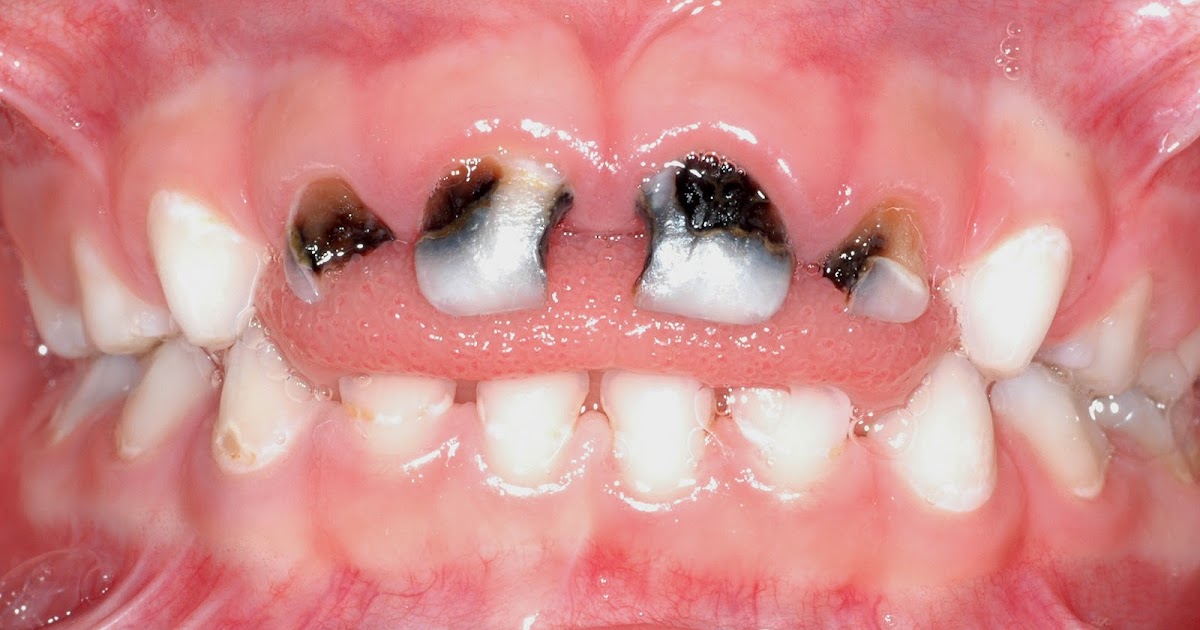 Grupo de estudios odontológicos de Cuenca: Caries "de biberón"