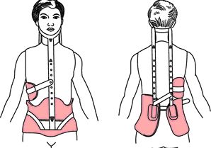myScoliosis: Treatment 2: Bracing