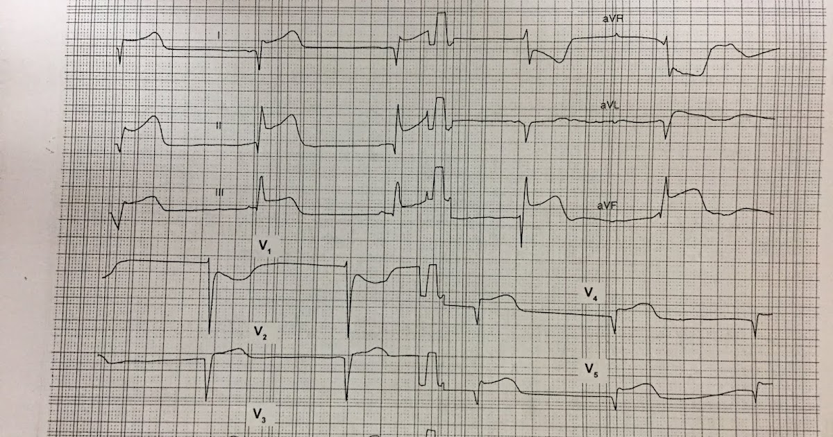 ECG EXERCISE 43,44