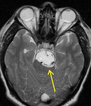 Ecchordosis physaliphora- Rare Retroclival Pathology - Sumer's ...