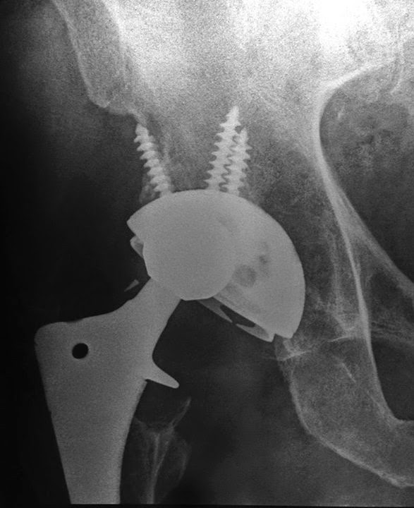 Traumatología y...: ¿Cuánto tiempo duran las prótesis de cadera?