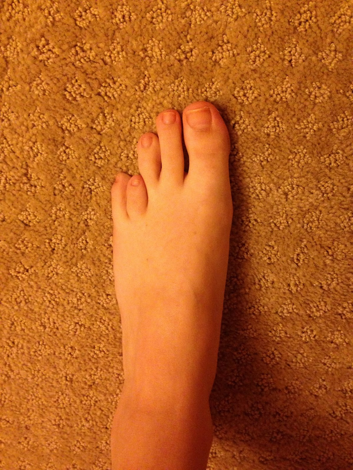 My Journey through Brachymetatarsia Surgery!: Background