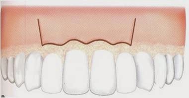 Apuntes De Odontología: principios generales en el diseño de colgajos y ...