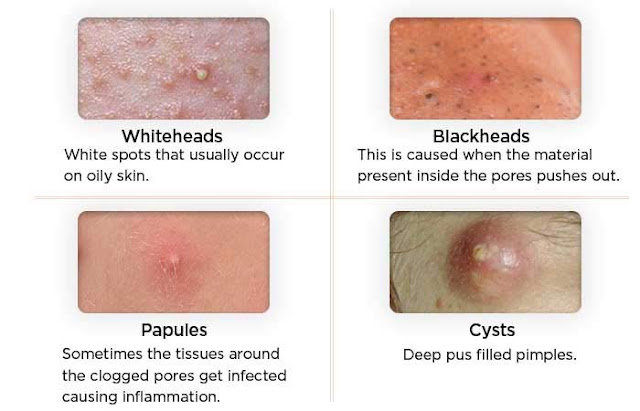 How To Get Rid Of Pimples (Acne) Overnight Fast - Health and Care