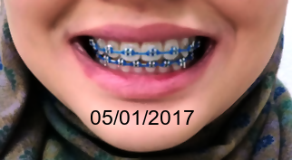 Brace Face = Gigi Besi: Power Chain & Headache