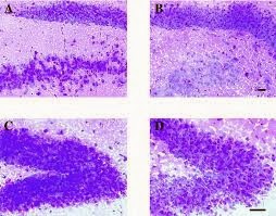 Medical Treatment Pictures-for Better Understanding: Sandhoff Disease