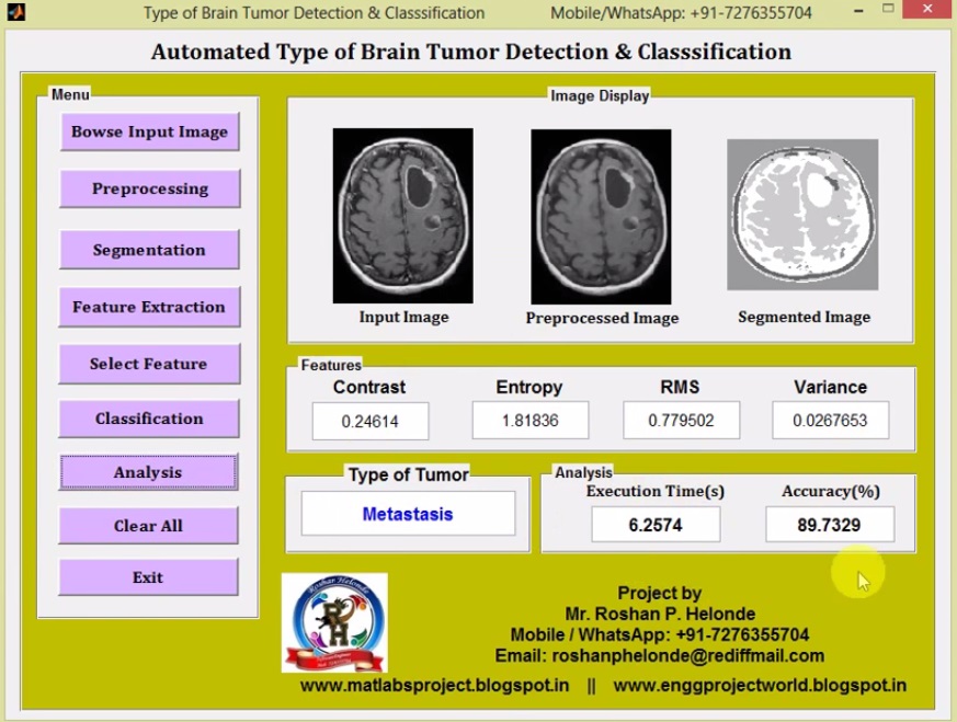 Types of Brain Tumor Detection Using Matlab Project Source Code (IEEE ...