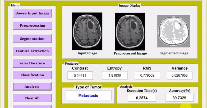 Types Of Brain Tumor Detection Using Matlab Project Source Code Ieee Based Project ~ Notes Planet