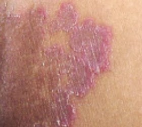 Kurap | Info Penyakit Kulit