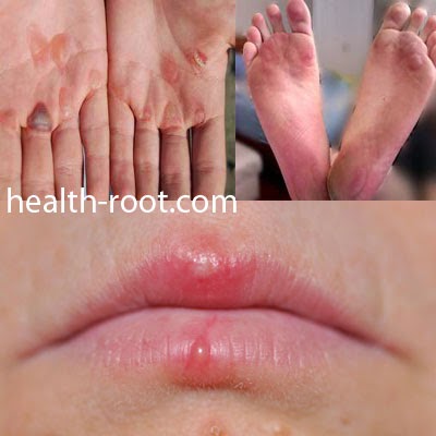 Health Root within Nature, Free Home Remedies & Health Guide: BLISTERS ...