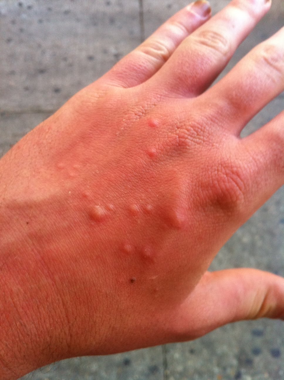 Adventure Motorcycling: Heat blisters from riding without gloves for a ...