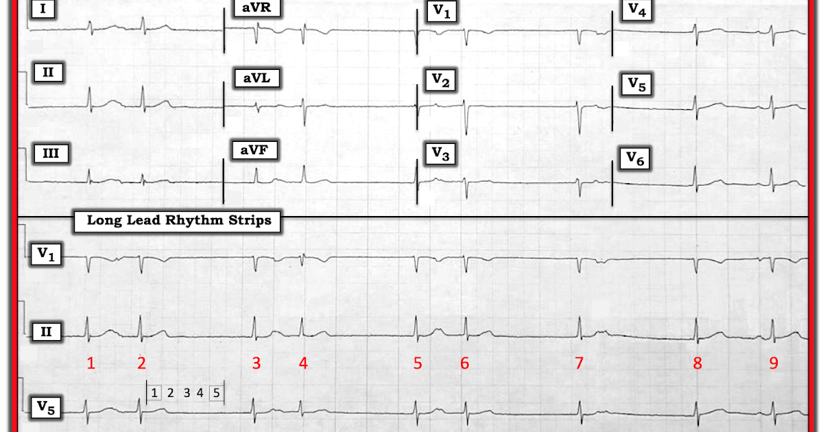 ECG Interpretation: ECG Blog #163 (Escape-Capture - Wenckebach - SA Block)