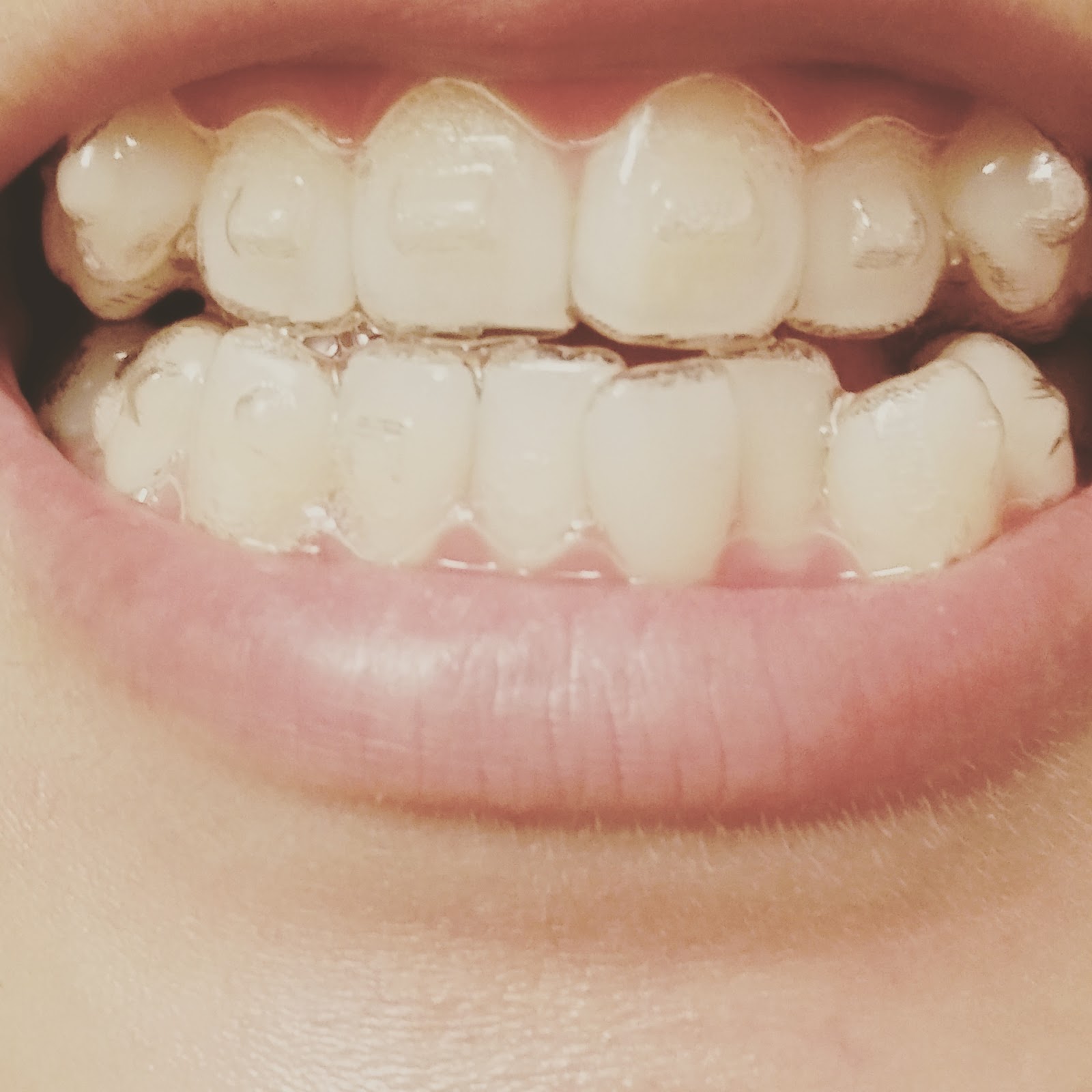 Invisalign Part 3: The full experience | SimplyJesMe