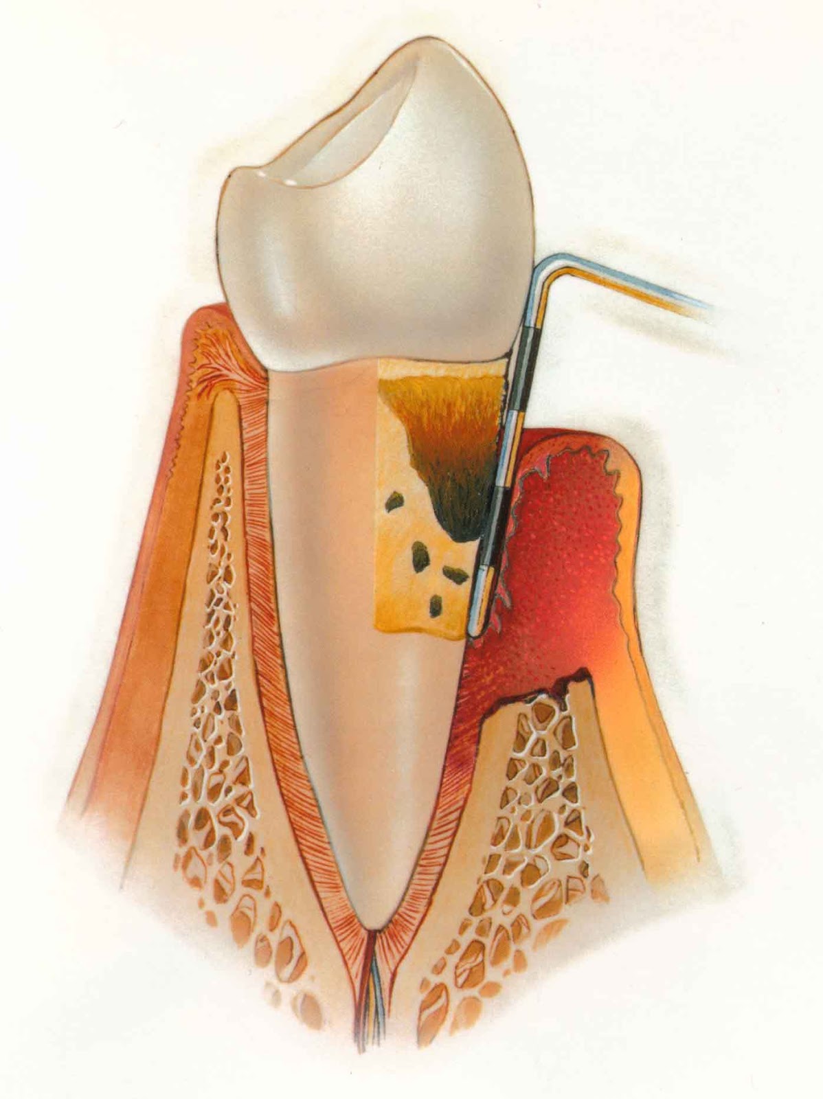 LA ODONTOLOGIA Y TU ;): QUE SON LAS CARIES?