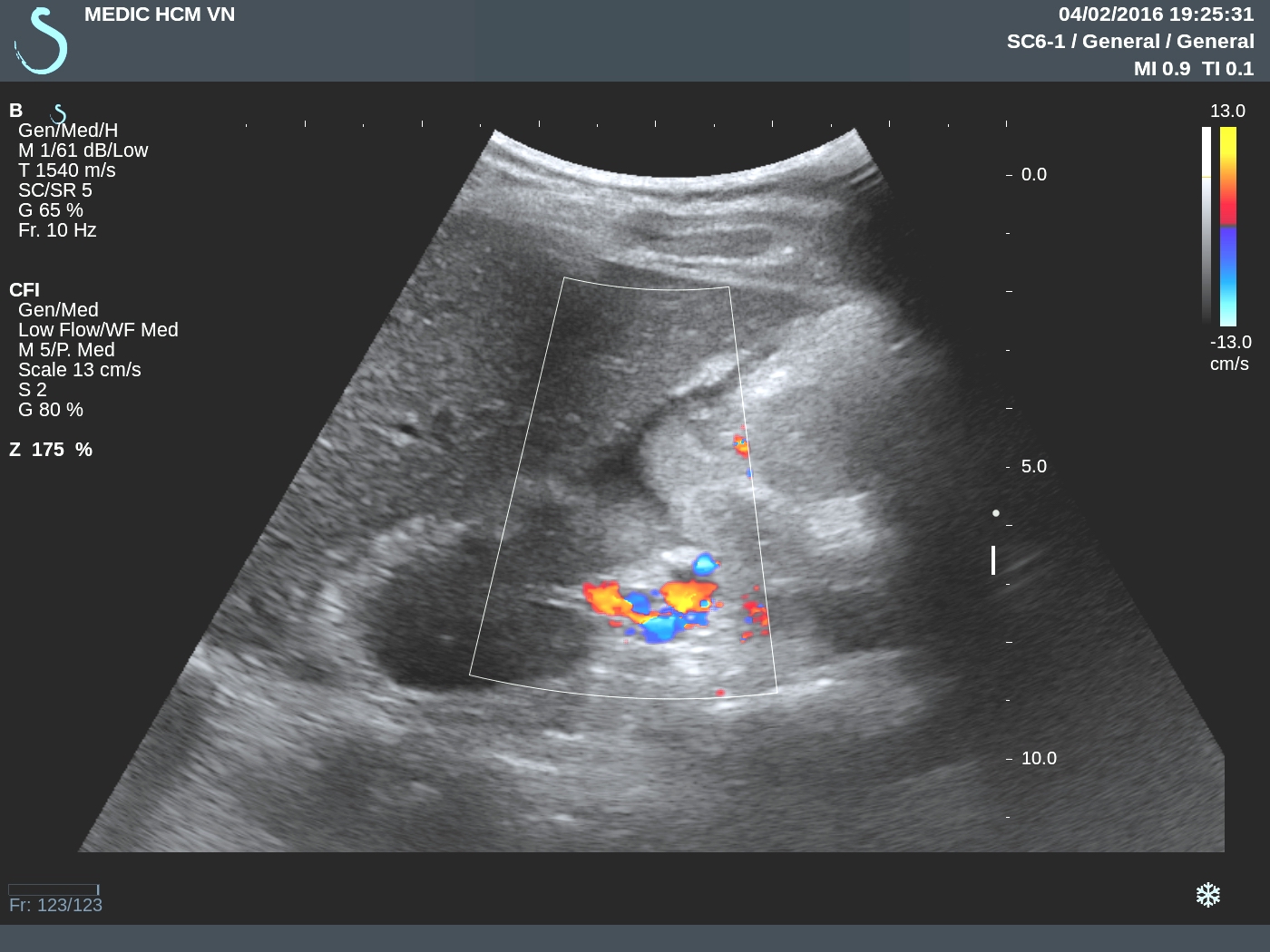 VIETNAMESE MEDIC ULTRASOUND: CASE 363: MURPHY'S SIGN POSITIVE, Dr PHAN ...