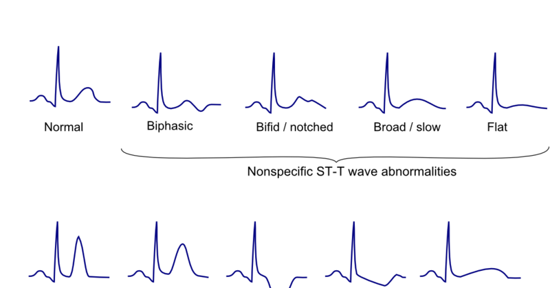 nieuw studiemateriaal: T Golf morphology - Critical Care Blog