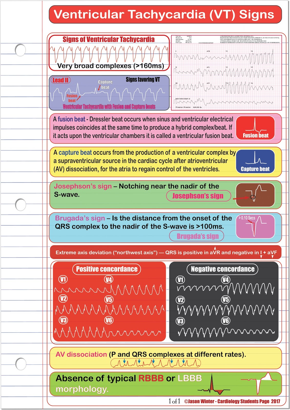 ECG Educator Blog : Is it VT?
