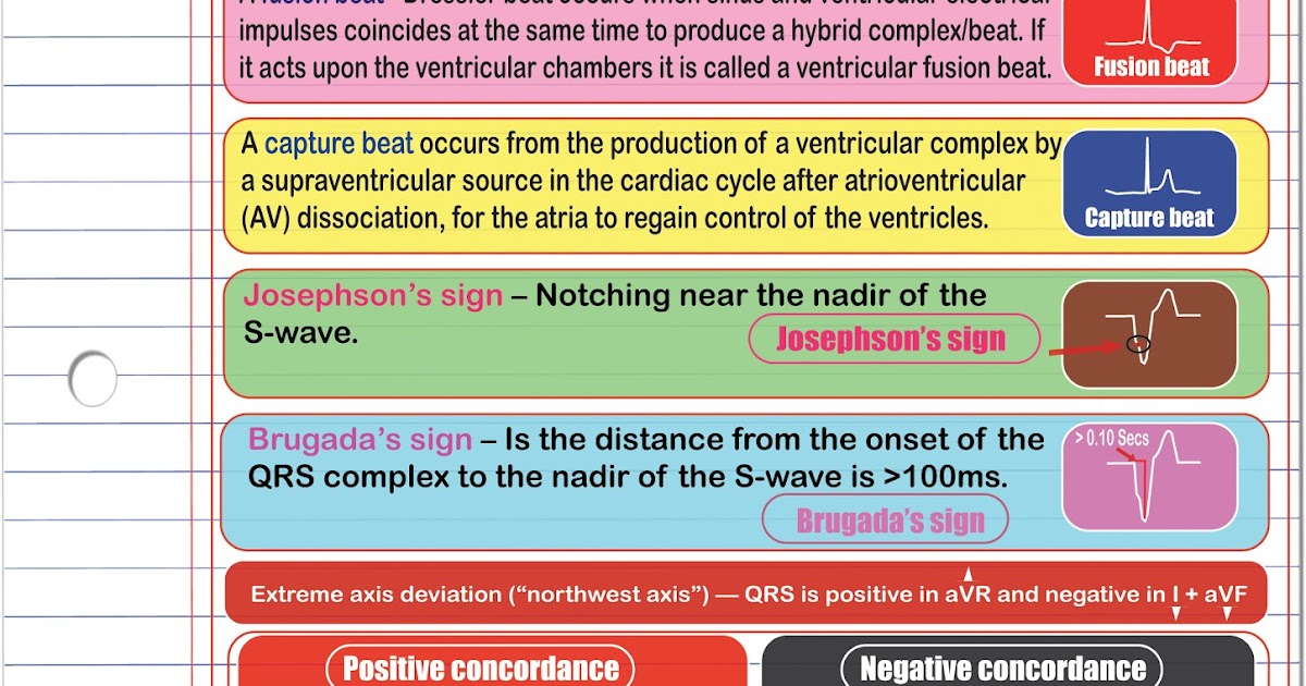 ECG Educator Blog : Is it VT?