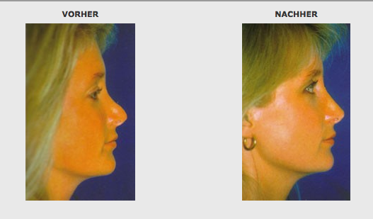 Rhinoplasty Journey: Prof. Dr. Werner Mang, Germany
