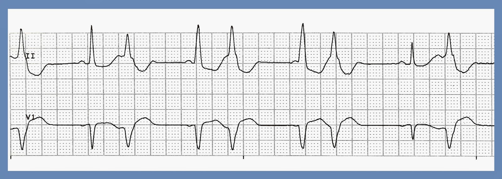 Float Nurse: Various Bigeminal PVCs