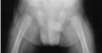 Syphilis in Pregnancy and Its Affects On Newborn Signs Diagnosis and ...