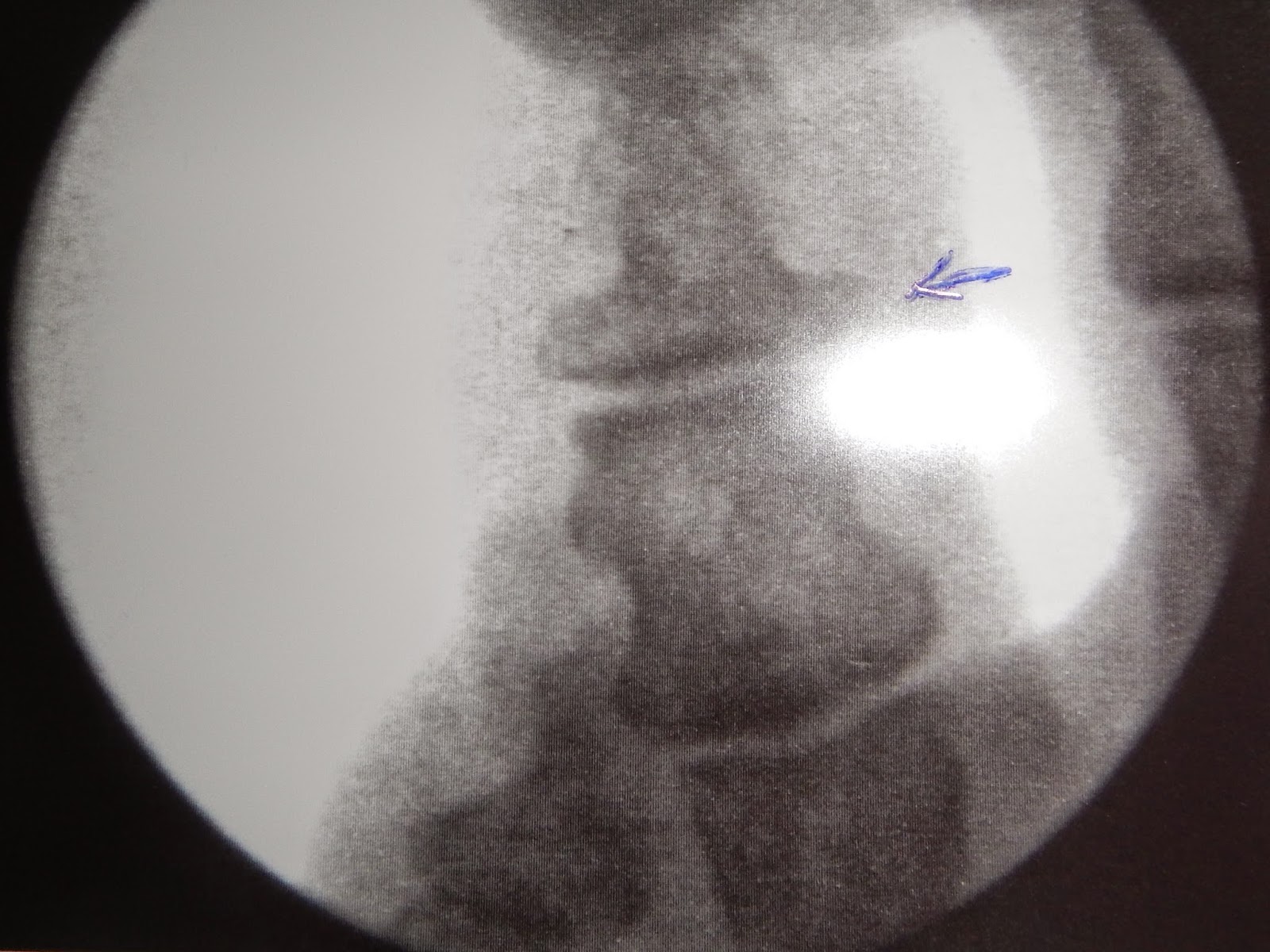 Podo Basas al Día: Condilectomía. Heloma interdigital. Ojo de gallo ...