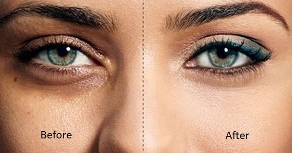 Effective Dark Circles Cream to Remove Black Spots Under Eyes - Skin Care