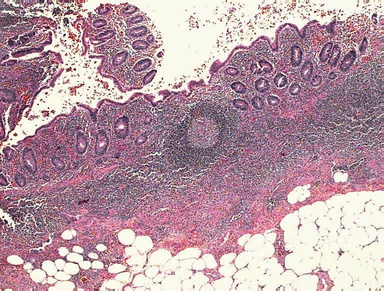 Patología 2014- Pilar Herranz: Morfología de la inflamación aguda
