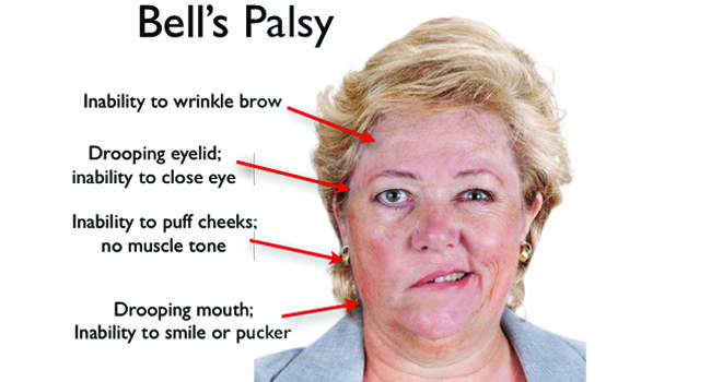 Cara Mengobati Bell’s Palsy ~ Khasiat Teripang Emas